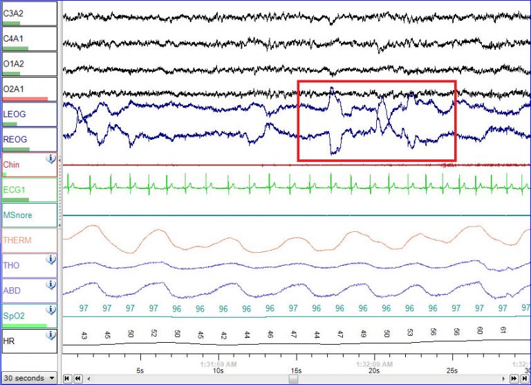 How is Polysomnography Used to Diagnose Sleep Disorders?